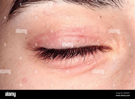 Eczema Around Eyes Stinging At Helen Terpstra Blog