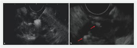 Eus Guided Laser Lithotripsy Successful Pancreatic Duct Stone Download Scientific Diagram