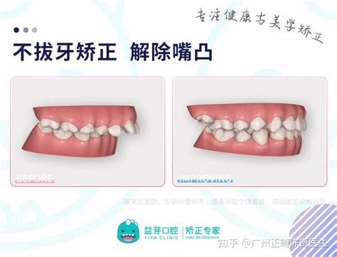【早矫案例】上颌前突下颌后缩，替牙期解决牙齿、颌骨、肌肉等多个维度的问题！ 知乎