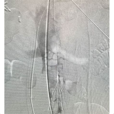 Venogram Post Suction Thrombectomy With The Angiovac Device Download Scientific Diagram