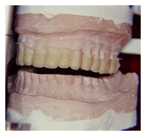 A Maxillary Occlusal Acrylic Splint Positioned In The Second Master