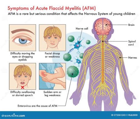 Afm A Rare But Serious Condition Mohamed Rishal Posted On The Topic Linkedin
