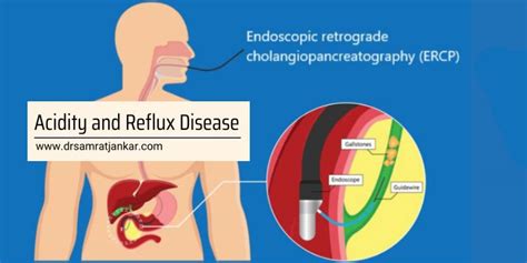 Everything You Need To Know About The Ercp Procedure