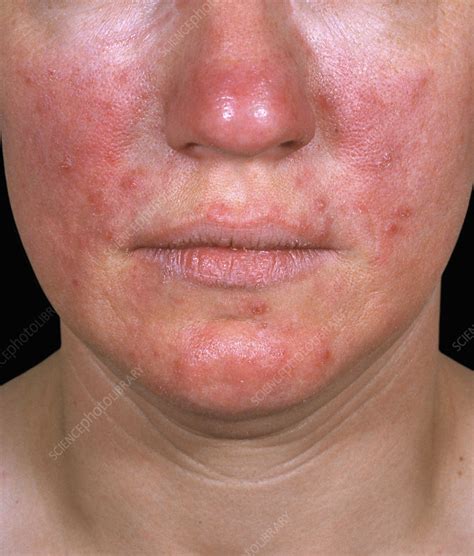 Acne Rosacea Chin