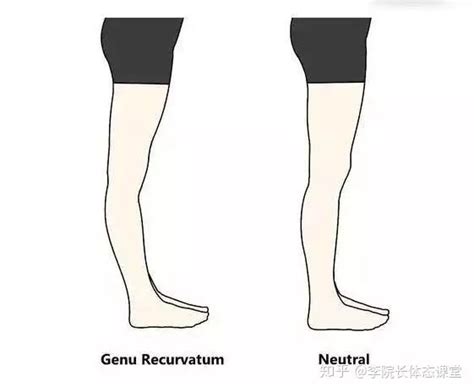如何判断有没膝超伸？ 知乎