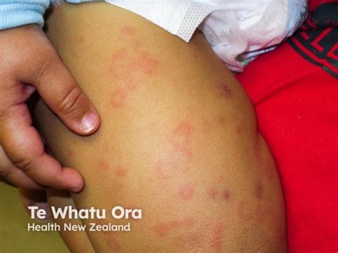 Histologia De Vasculite Urticariforme Urticarial Vasculitis Histology