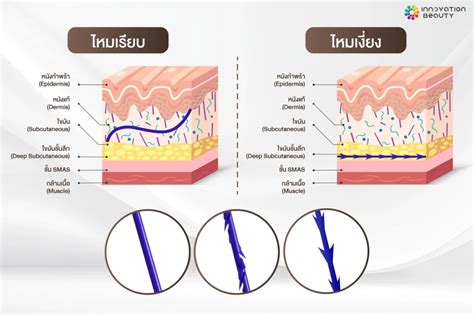 เจาะลึก การร้อยไหม pdo polydioxanone คืออะไร ทำไมถึงเป็นที่นิยม
