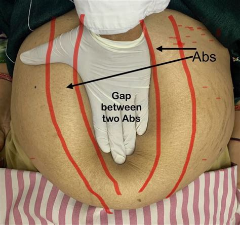 Divarication Of Recti Open Or Laparoscopic Hernia Surgery Centre Posted On The Topic Linkedin