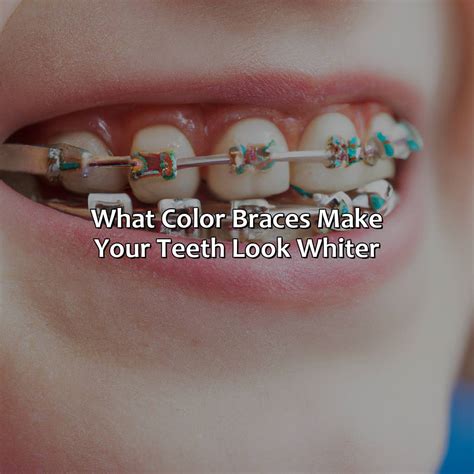 Braces Colors That Make Teeth Look White At June Weiss Blog