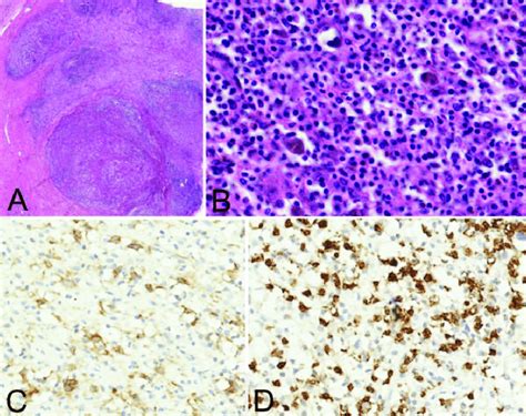 Biopsy Images A He Â 50 Showing Sclerosis Nodules Divided By Fibrous Download Scientific