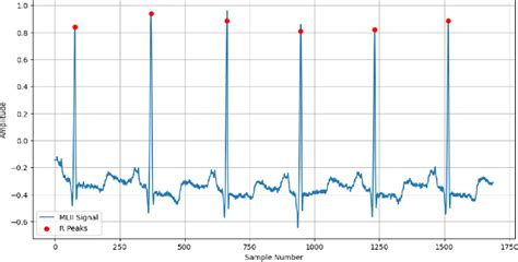 Figure 2 From A Novel Multi Class Classification Method For Arrhythmias Using Hankel Dynamic