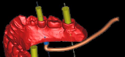 Digital Implantology Accurate 3d Implant Placement Using Computer Guided Systems Implantology
