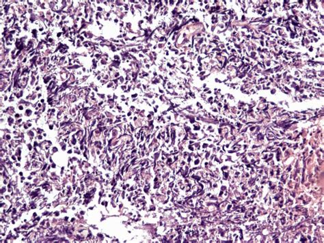 On High Power Diffuse Infiltration Of Mucosa By Atypical Lymphoid