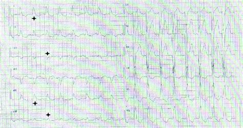 ECG Showing True Left Bundle Branch Block QRS Duration 160 Myocardial Download Scientific