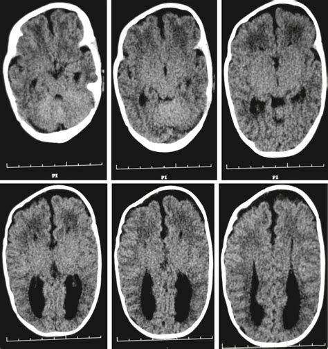 Multiple Suture Nonsyndromic Craniosynostosis Neupsy Key