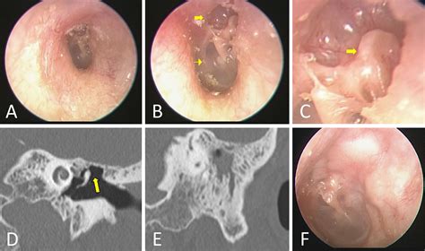 Tympanic Membrane Cholesteatoma