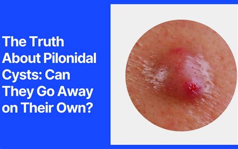 Treatments For Pilonidal Disease Pilonidal Institute Los Angeles