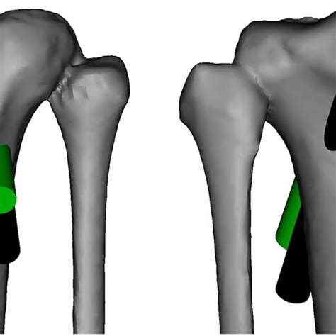 Schematic Of Different Tibial Tunnel Placement Yellow Tunnel Am Schematic Of Different Tibial Tunnel Placement Yellow Tunnel Am