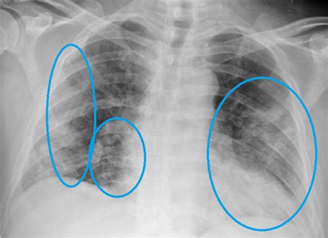코로나 환자 뿌옇게 변한 폐 X레이만으론 잡아내기 네이버 블로그