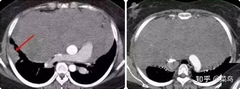 胸腺肿瘤的病理和影像学诊断（胸腺瘤篇） 知乎