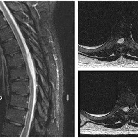 A Sagittal T2 Weighted And Corresponding Axial Cross Sections At Two
