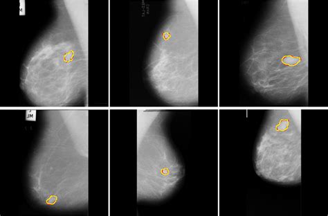 The Visual Assessment Of Breast Tumor Segmentation Using Our Download Scientific Diagram