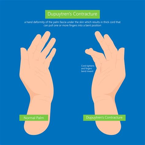 Dupuytrens Nodules Over 9 Royalty Free Licensable Stock Illustrations And Drawings Shutterstock