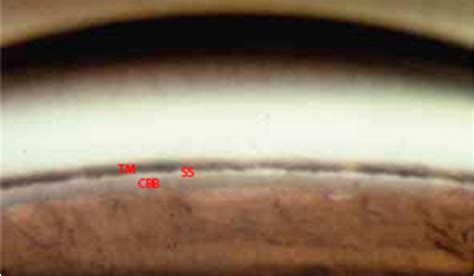 Gonioscopy Cure Glaucoma Foundation