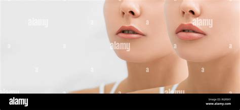 Female Face Present Before And After Lips Filler Injections Lip