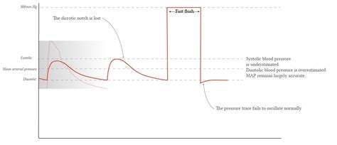 Arterial Line Dynamic Response Testing Deranged Physiology