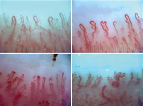 Polymyositis Anti Jo1 And Anti Ro52 Positive With Scleroderma Like Pattern Download Scientific