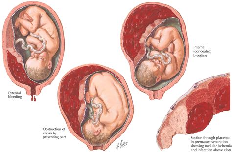 Placental Abruption Clinical Tree