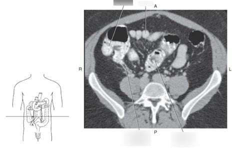 Axial Ct Of Hepatic Flexure And Transverse Colon And Splenic Flexure Diagram Quizlet