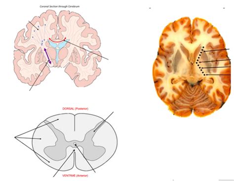 Spinal Cord Ascending Tracts And Sensation Diagram Quizlet