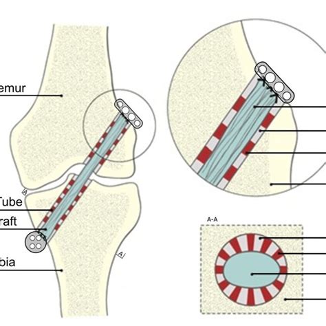 Three Dimensional Visualization Of The Tibial Tunnel In Sagittal Three Dimensional Visualization Of The Tibial Tunnel In Sagittal
