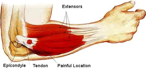 Common Extensor Tendon Anatomy Wrist Flexor And Extensor Group