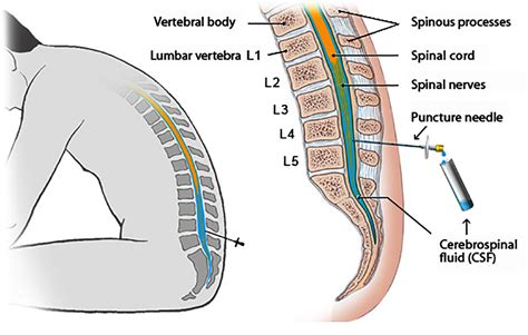 Lumbar Puncture Landmarks
