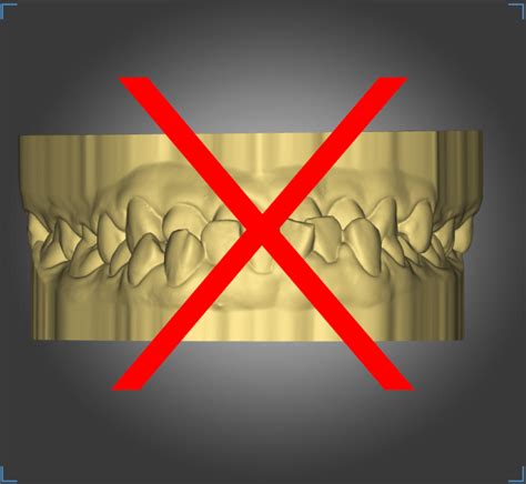 Designsoftware Viewer Dentone Clearaligner 3d Orthodontic Software