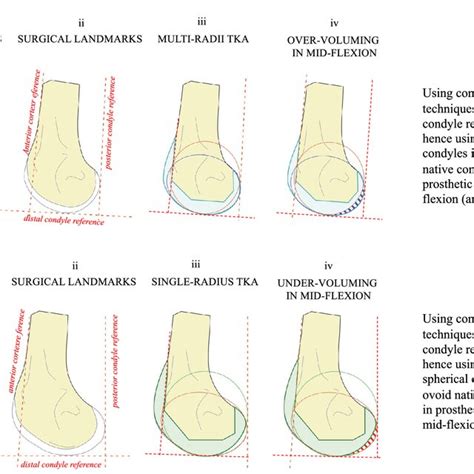 Discrepancy Between The Profile Of The Native Condyles And The