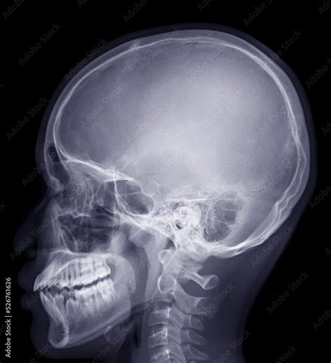 Skull X Ray Image Of Human Name Is Skull Lateral View Isolated On Black