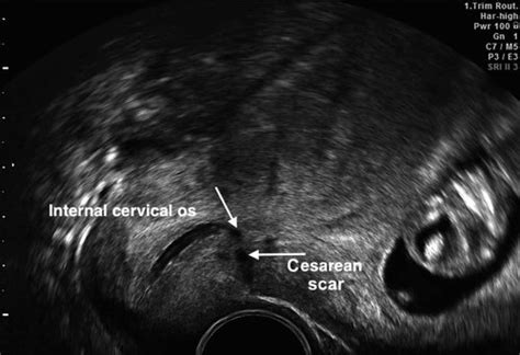 Standardized Approach For Imaging And Measuring Cesarean Section Scars