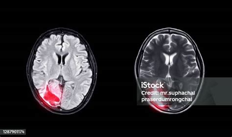 뇌후경병을 보여주는 Mri 뇌 축 T2w 감각과 T2w 뷰를 비교합니다 Mri 스캐너에 대한 스톡 사진 및 기타 이미지 Mri 스캐너 Mri 스캔 지력 Istock