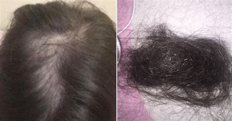 23 Pictures That Show The Reality Of Living With Skin Picking And Hair