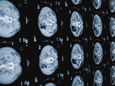 Cirrhosis Of The Liver Life Expectancy Stages Prognosis And More