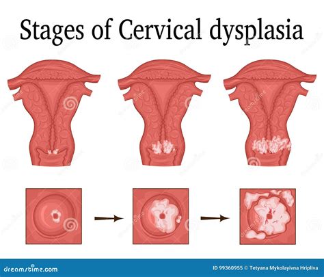 Stages Of Uterine Prolapse Female Reproductive Organs Diagram And