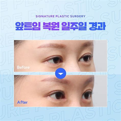 시그니처성형외과의원 앞트임 복원 일주일 후기 마음에 들지 않았던 트임은 앞트임복원 으로 Facebook
