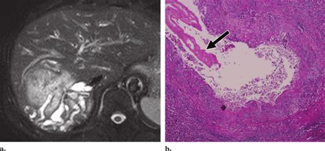Mass Forming Cholangiocarcinoma In A Patient With Clonorchiasis A