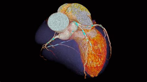 A Comprehensive Cardiac Ct Examination Ct Angiography Ct Stress Perfusion And Ct Delayed