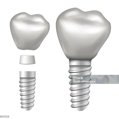 치과 임 플 란 트 벡터입니다 구조를 이식 크라운 인접 나사입니다 현실적인 격리 된 그림 개념에 대한 스톡 벡터 아트 및 기타 이미지 Istock