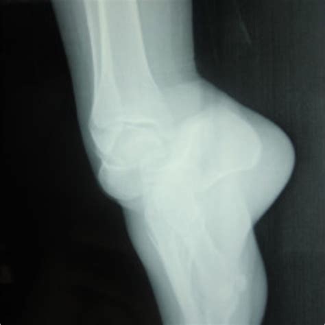 Pdf Closed Medial Total Subtalar Joint Dislocation Without Ankle